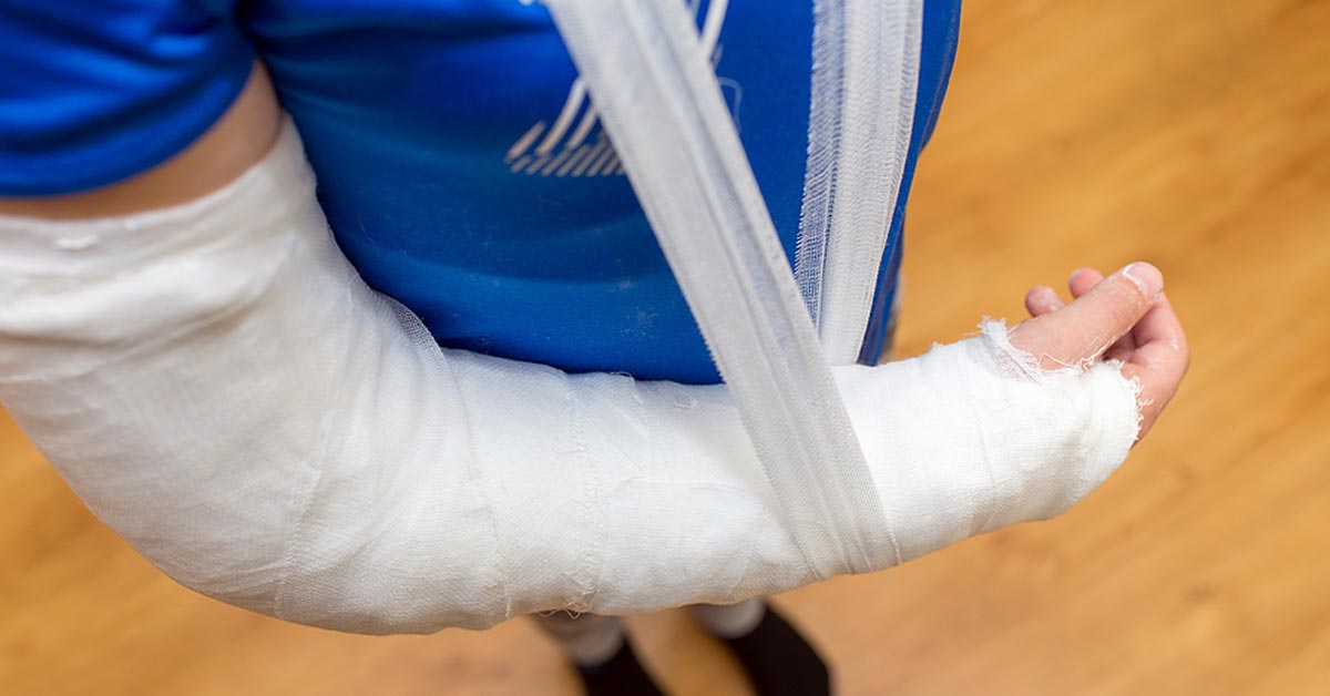 Fractured Elbow Cast