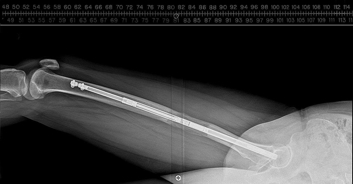 Stature Lengthening Surgery | Hospital for Special Surgery