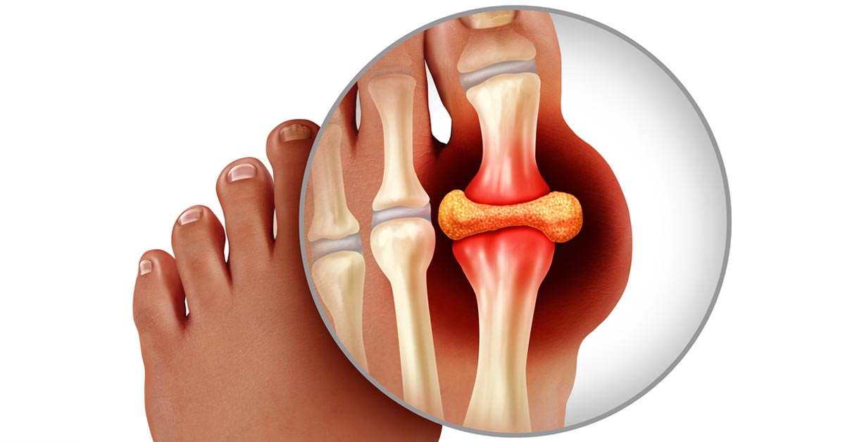Gout/Gouty Arthritis In Depth: Risk Factors, Treatment