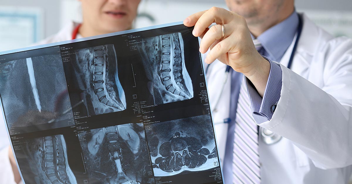 Lumbar Fusion Surgery to Relieve Lower Back Pain