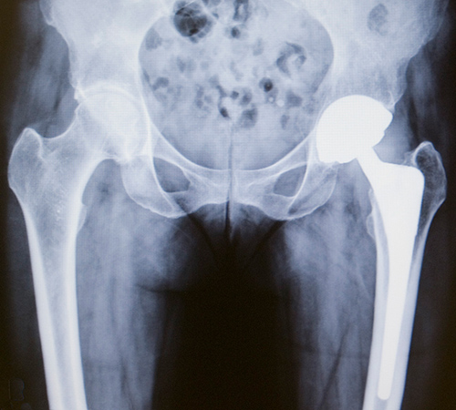 Hip Surgery Pictures Hip Surgery Pictures